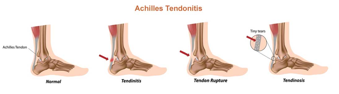 Achilles Problems | Foot Problems