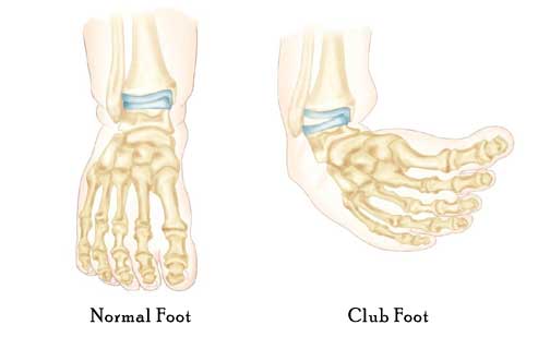 Deformities | Foot Problems