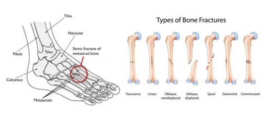 Common Foot Injuries | Foot Problems