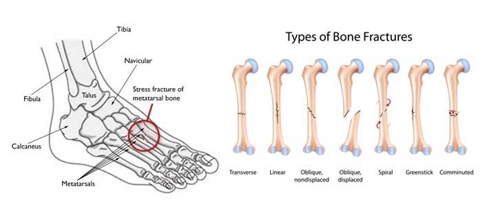 Common Foot Injuries | Foot Problems