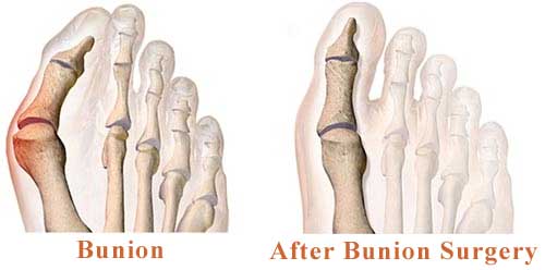 Bunion Surgery | Foot Surgery